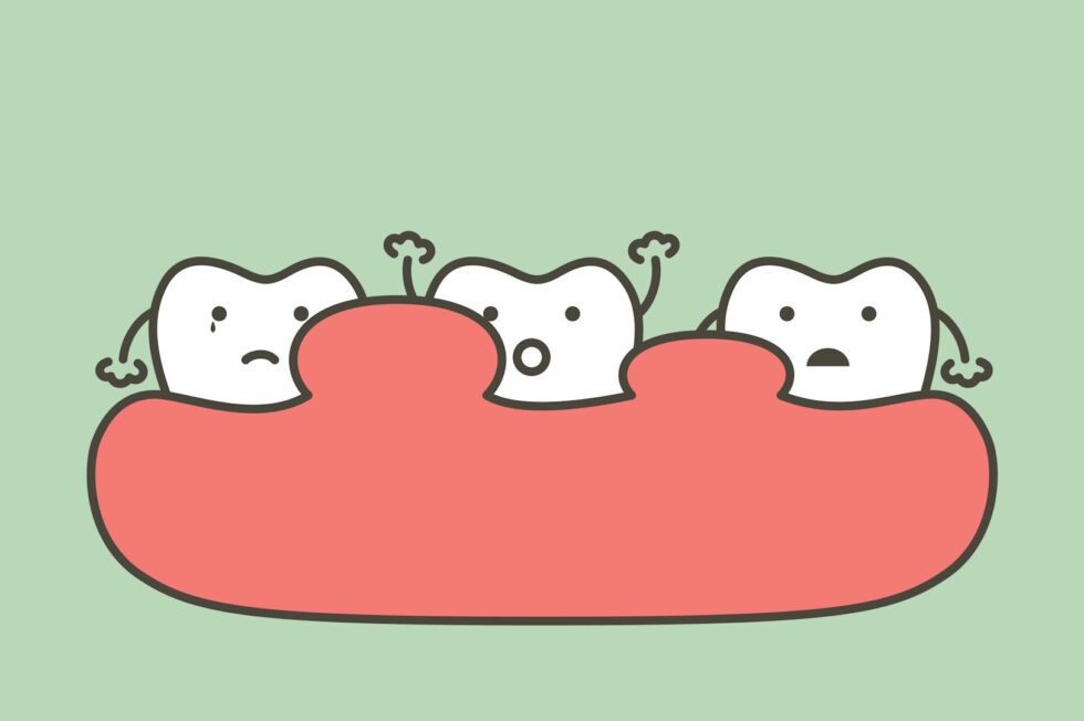 Ascesso gengivale: sintomi, cause e prevenzione